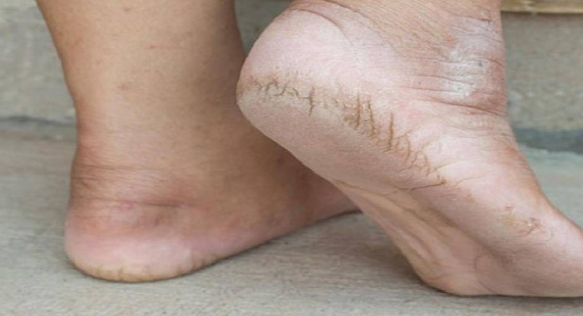 Follow these home remedies to soften cracked heels